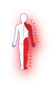 Radicular Pain - MSK Pain